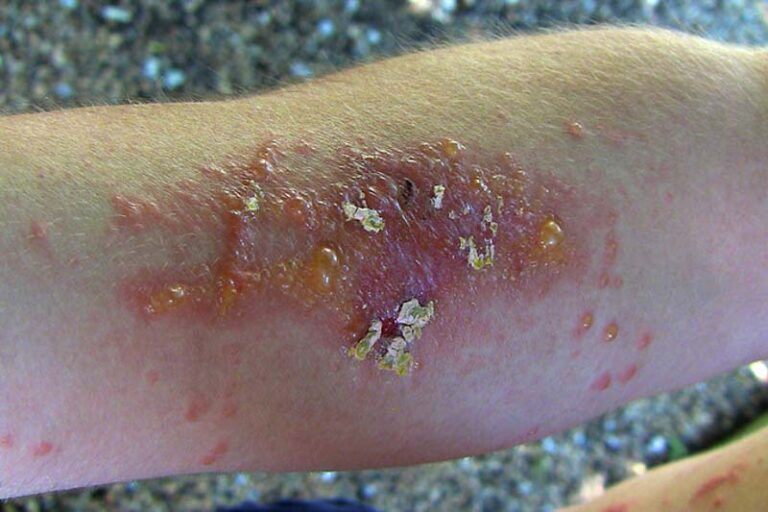 Poison Ivy (Toxicodendron radicans): An Itchy Native Plant